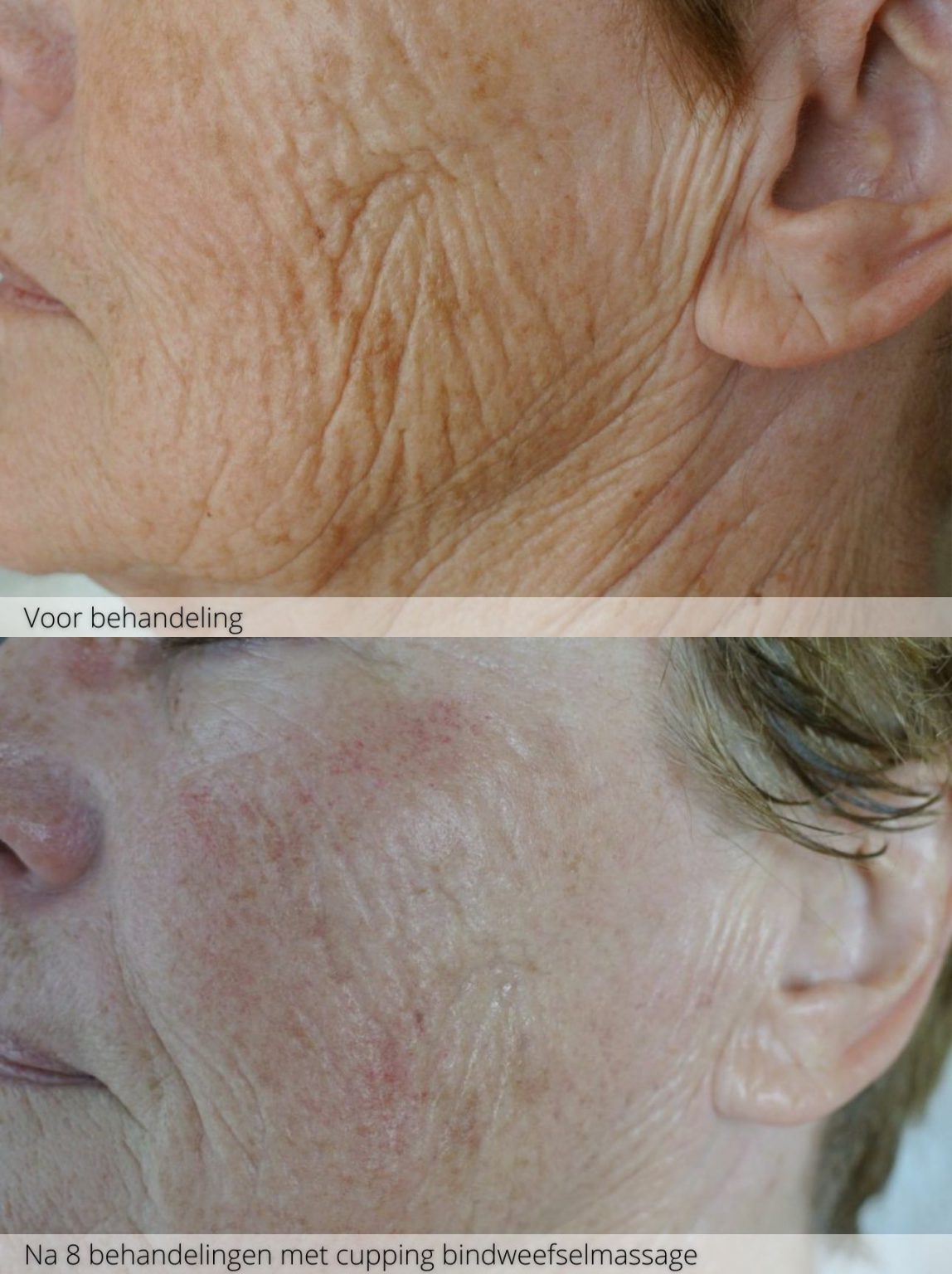 Facial cupping bindweefselmassage | Diferencia – Praktijk voor ...